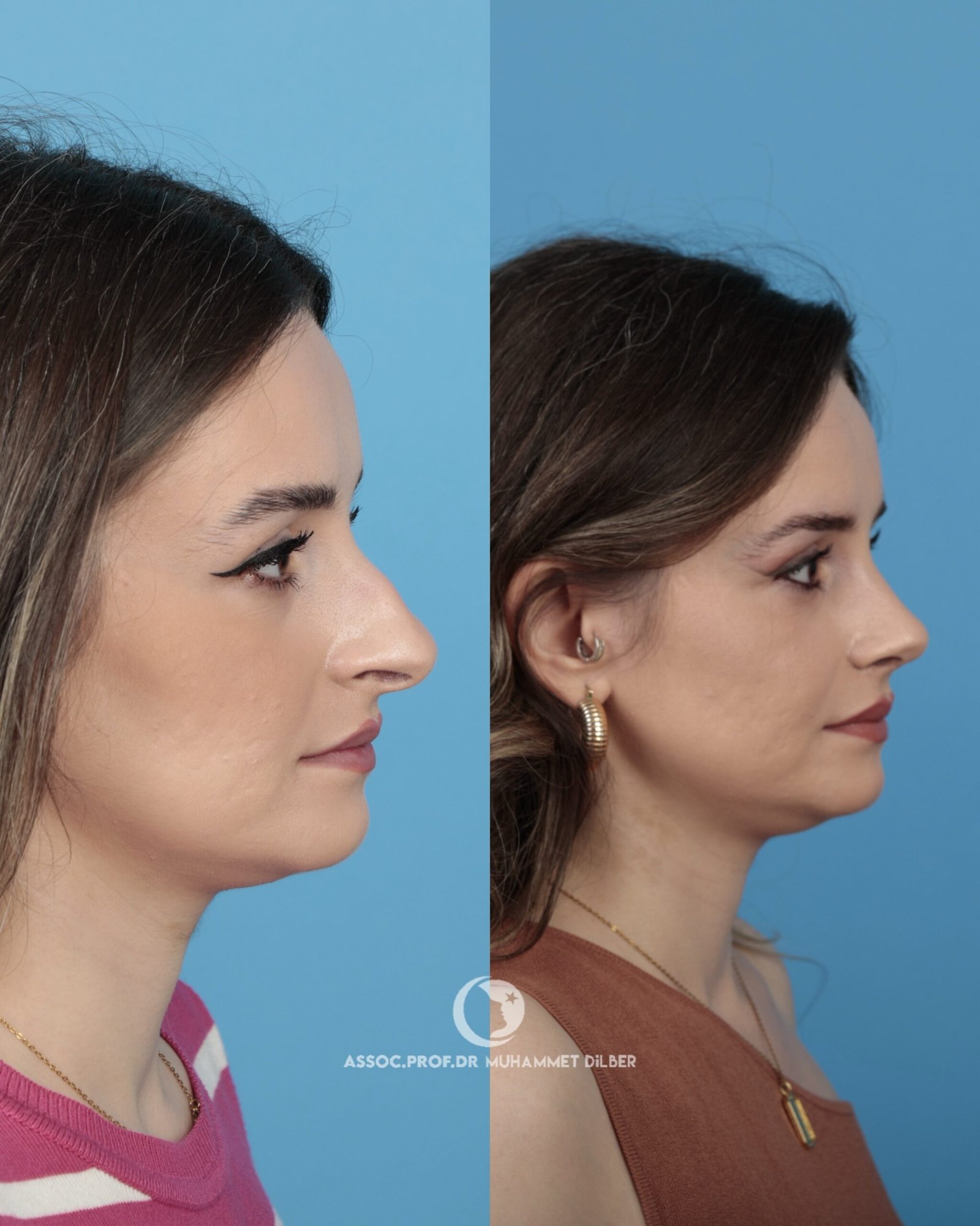 Why Are My Nostrils So Visible? Can surgery really fix this "visible ...