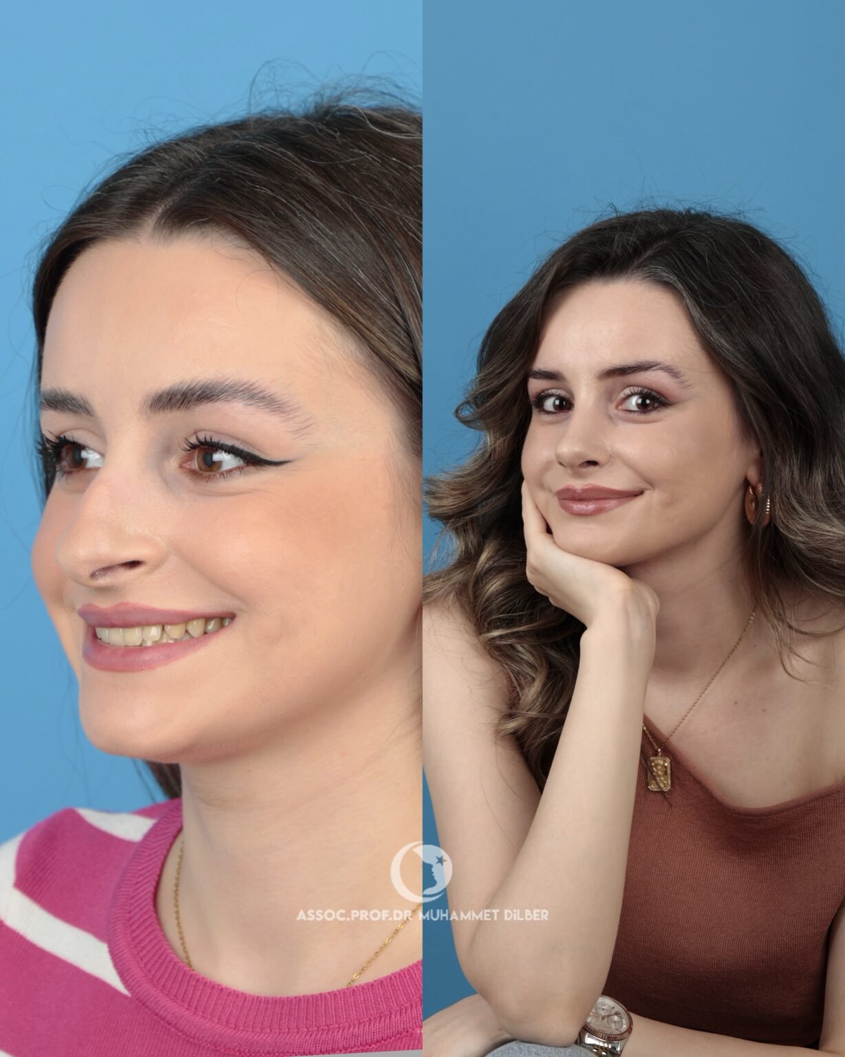 Why Are My Nostrils So Visible? Can surgery really fix this "visible ...