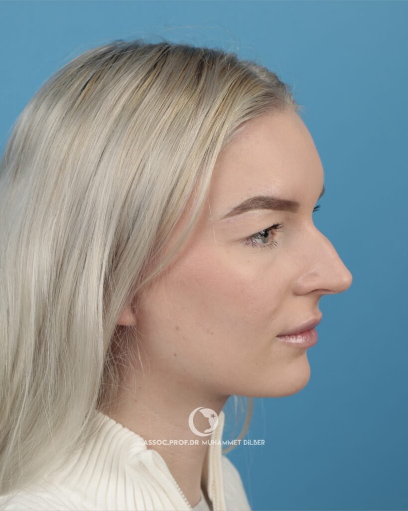 Long Nose Bridge"? How Surgeons Think About Proportion and Rhinoplasty